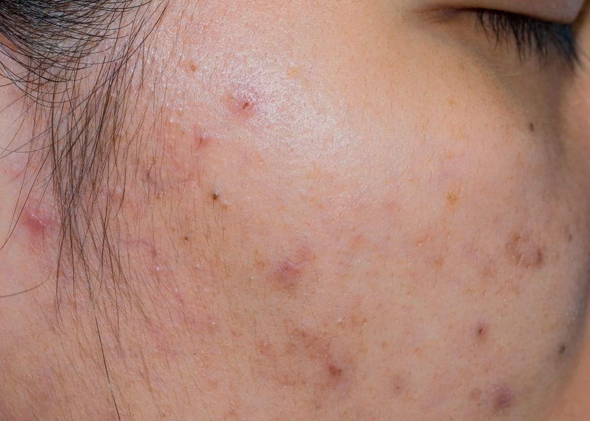 Fungal Acne vs. Closed Comedones: How To Tell The Difference